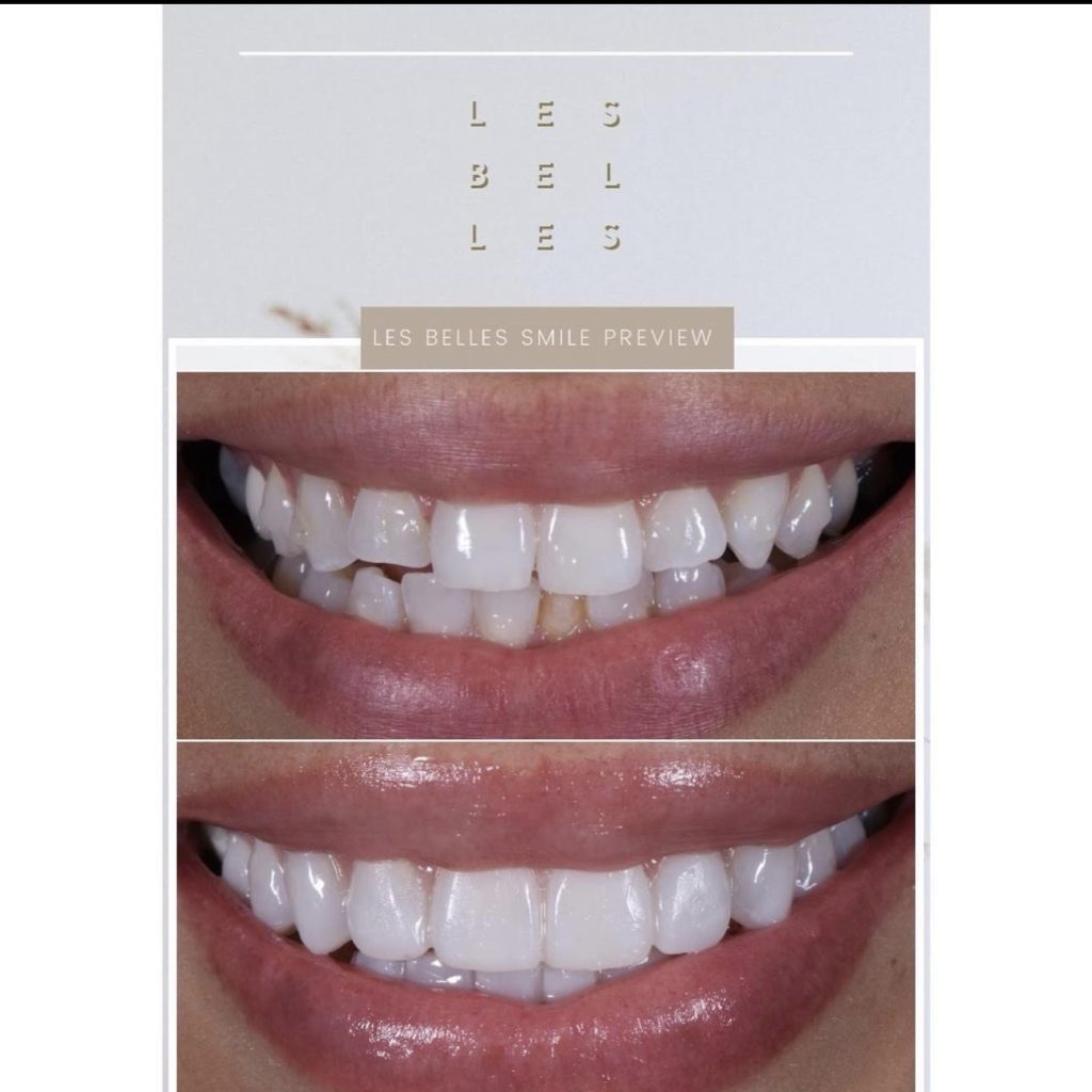 NYC Smile Makeover Preview | UES Visualize Your Perfect Smile