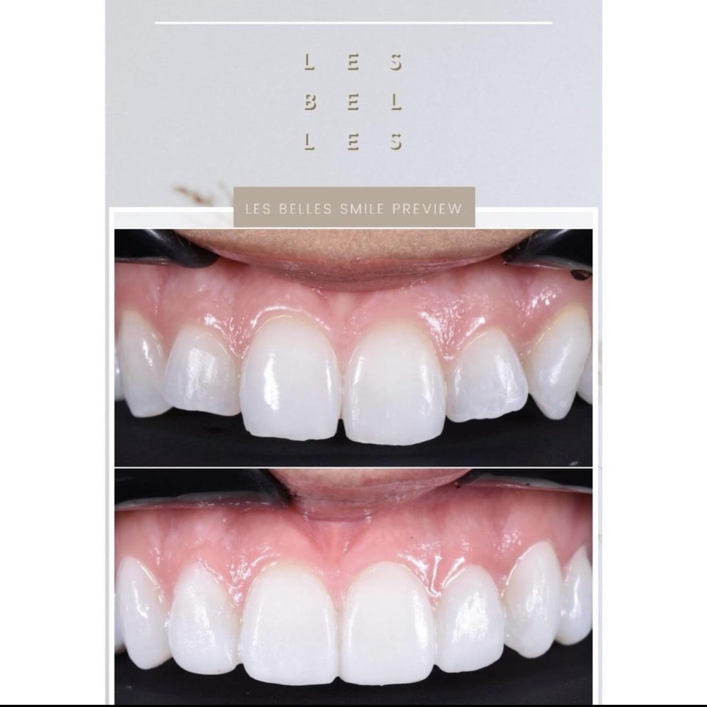 NYC Smile Makeover Preview | UES Visualize Your Perfect Smile