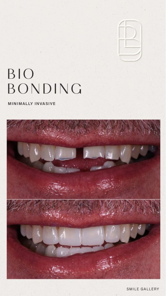NYC Bio Bonding™ | Upper East Side Cosmetic Bio Bonding™
