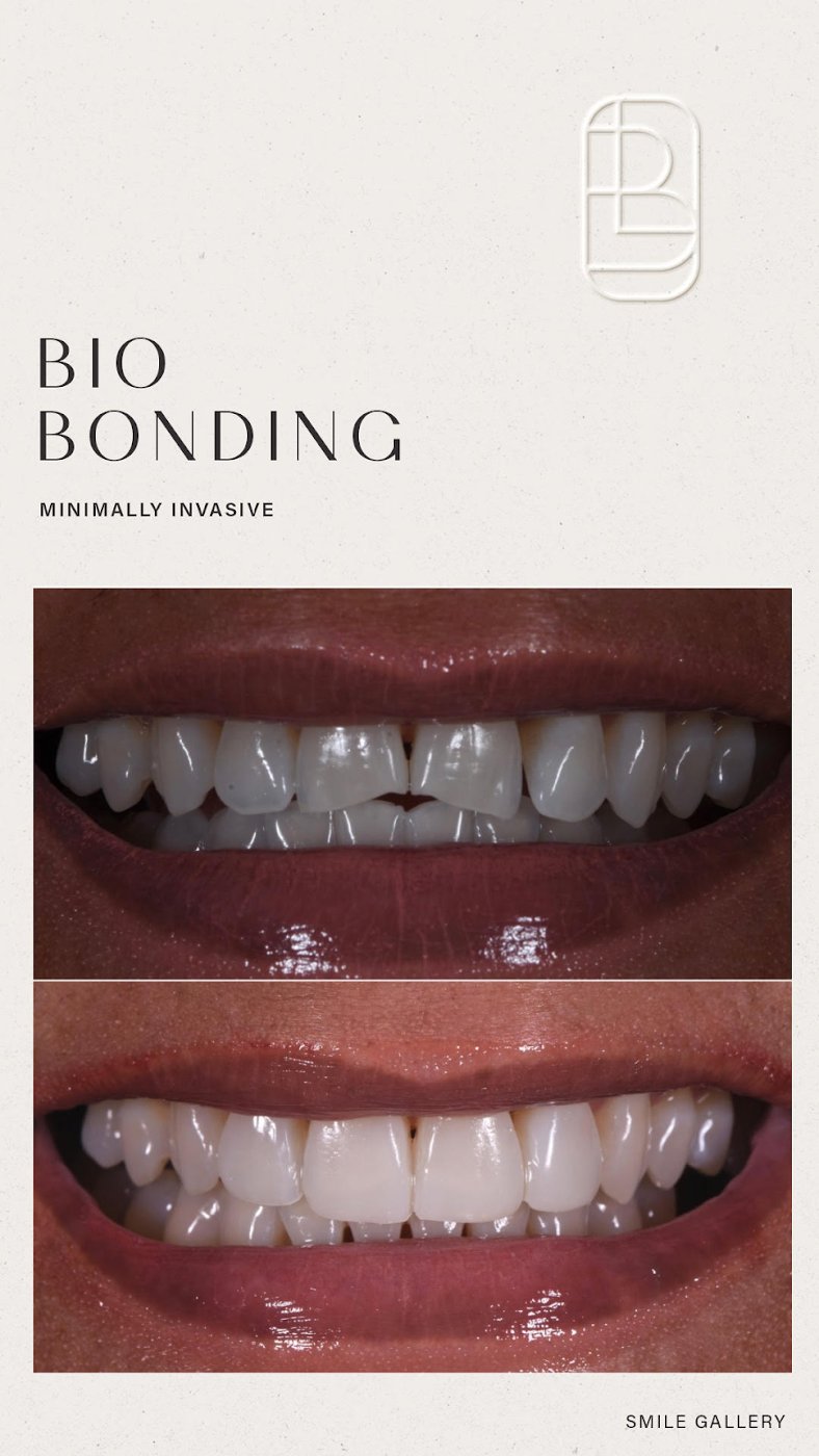 NYC Bio Bonding™ | Upper East Side Cosmetic Bio Bonding™