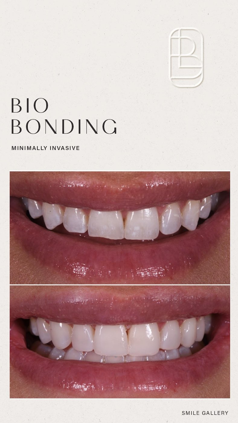NYC Bio Bonding™ | Upper East Side Cosmetic Bio Bonding™
