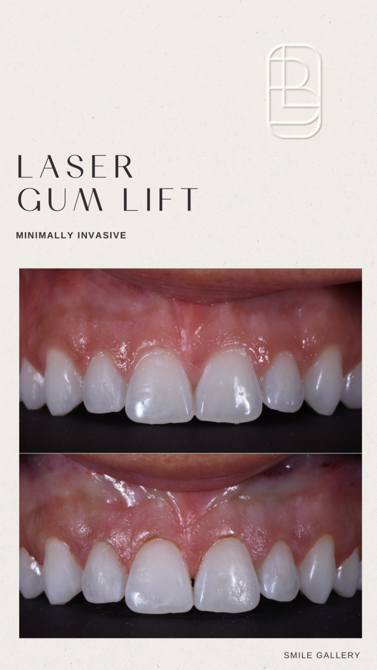 Gum Builder™ Non-Surgical Gum Regeneration | NYC Dentist