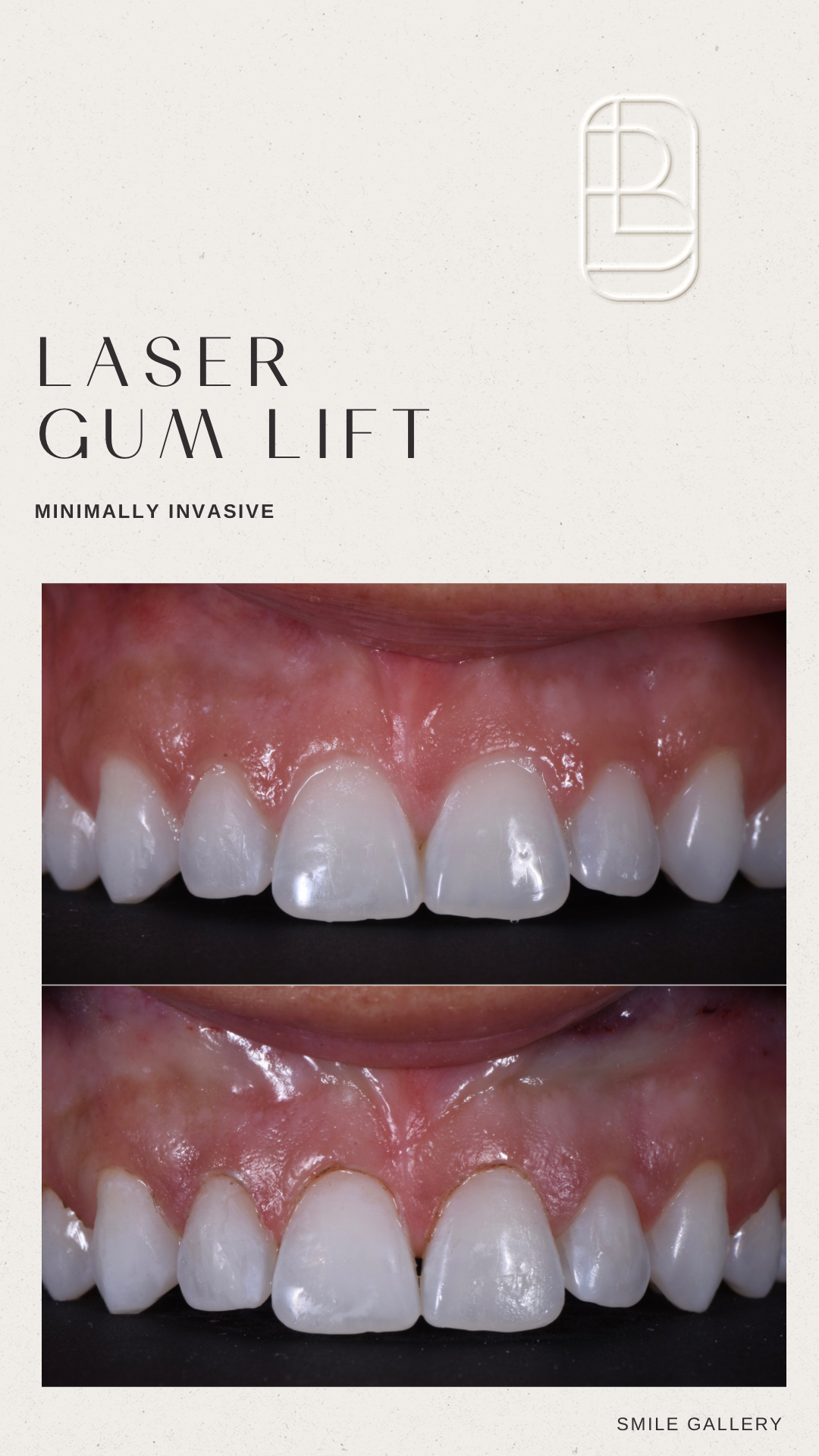 Gum Builder™ Non-Surgical Gum Regeneration | NYC Dentist